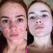 Acabe com a Acne